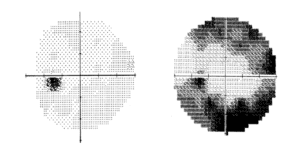 Champ visuel : périmétrie automatisée