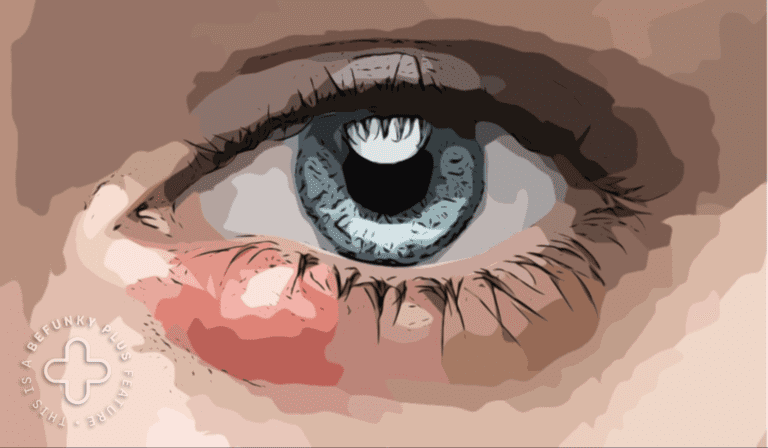 Comment différencier orgelet et chalazion