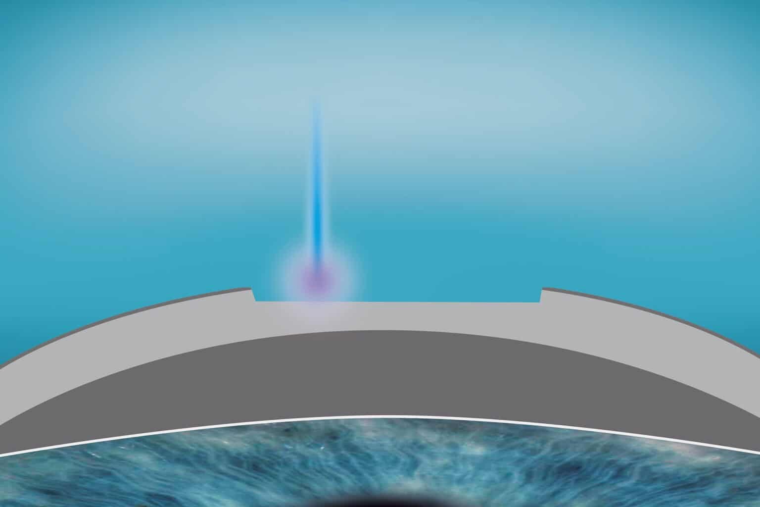 Trans-PKR : Chirurgie Réfractive 100% Laser sans Découpe